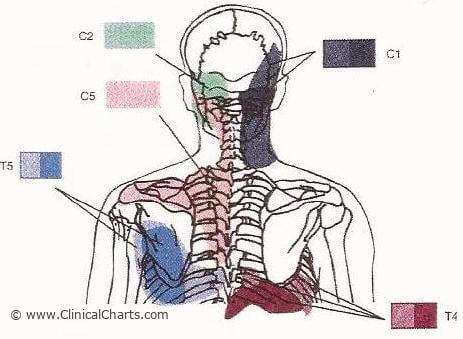 T5 Subluxation – Back To Life Chiropractic